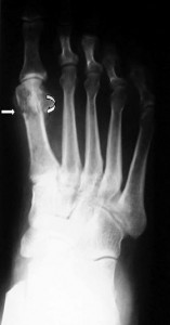Gout : Martel’s G Sign – Orthopaedics Plus