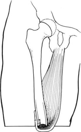 adductor myodesis – Orthopaedics Plus