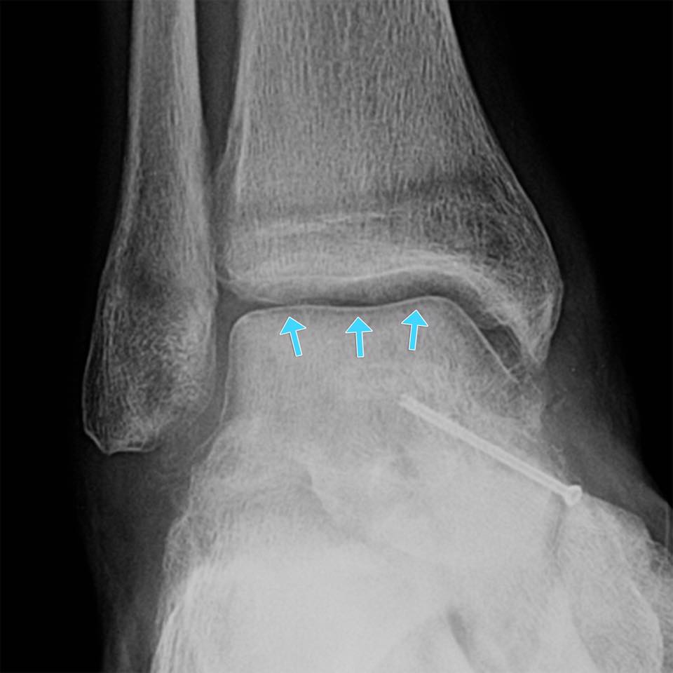 Hawkins Sign – Orthopaedics Plus